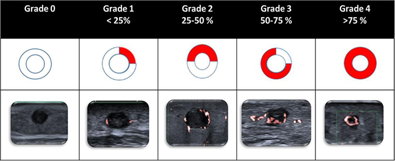 Venous vessel-wall assessment with superb microvascular imaging in ...