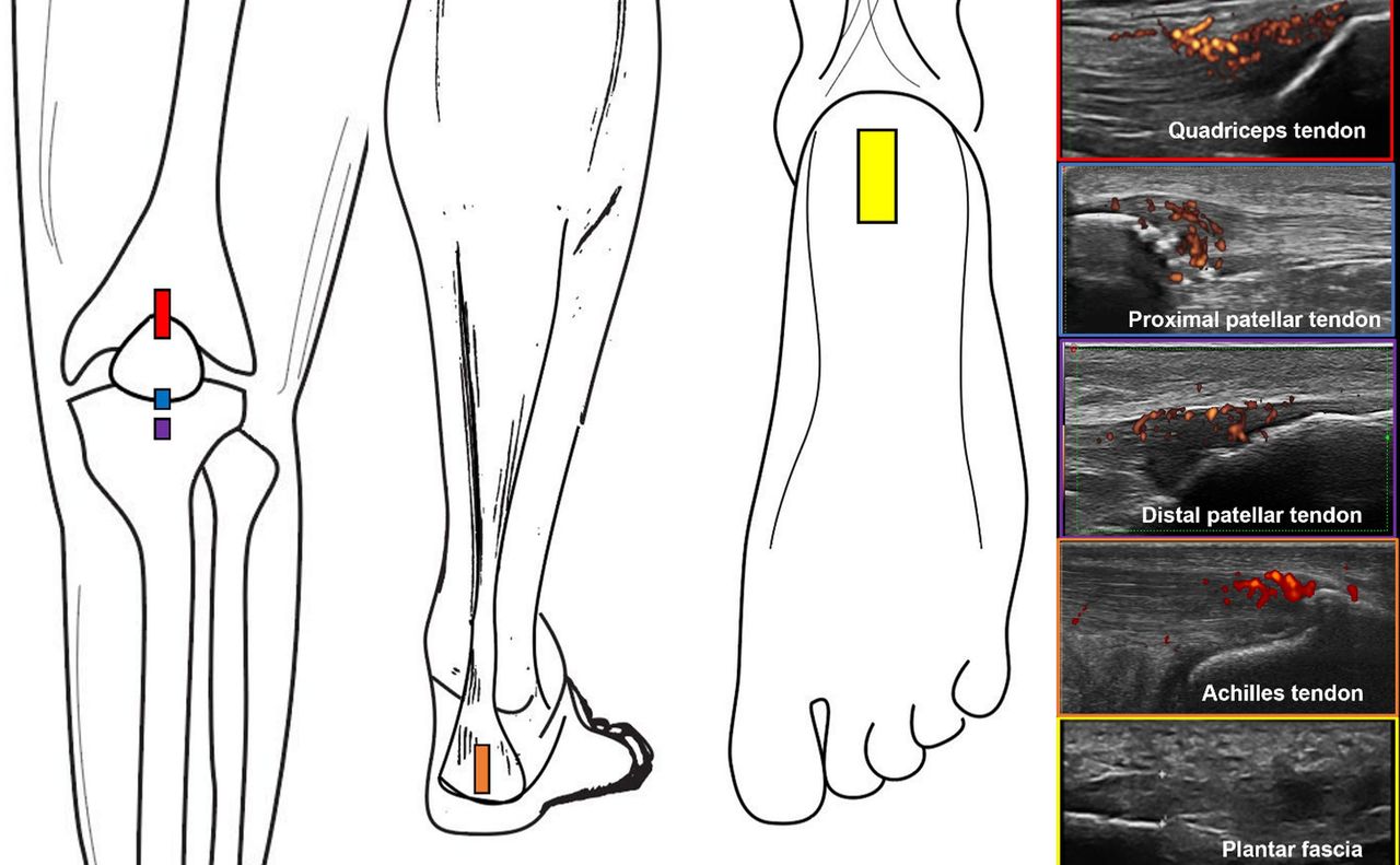 DEUS Enthesitis Index (DEI): a new tool integrating ultrasound and ...