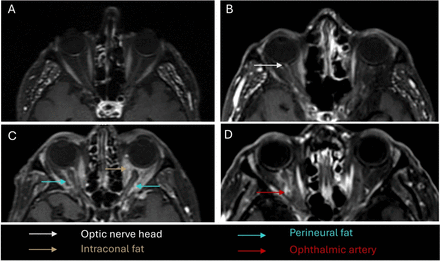 Orbital MRI for diagnosing giant cell arteritis in cases of anterior ...
